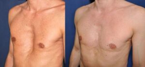 PECTUS EXCAVATUM – FR Medical