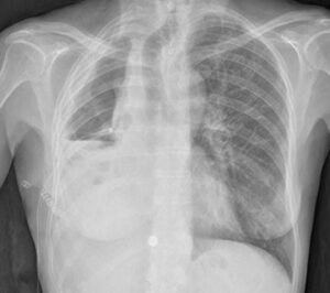 NOVATECH STERITALC ® – FR Medical