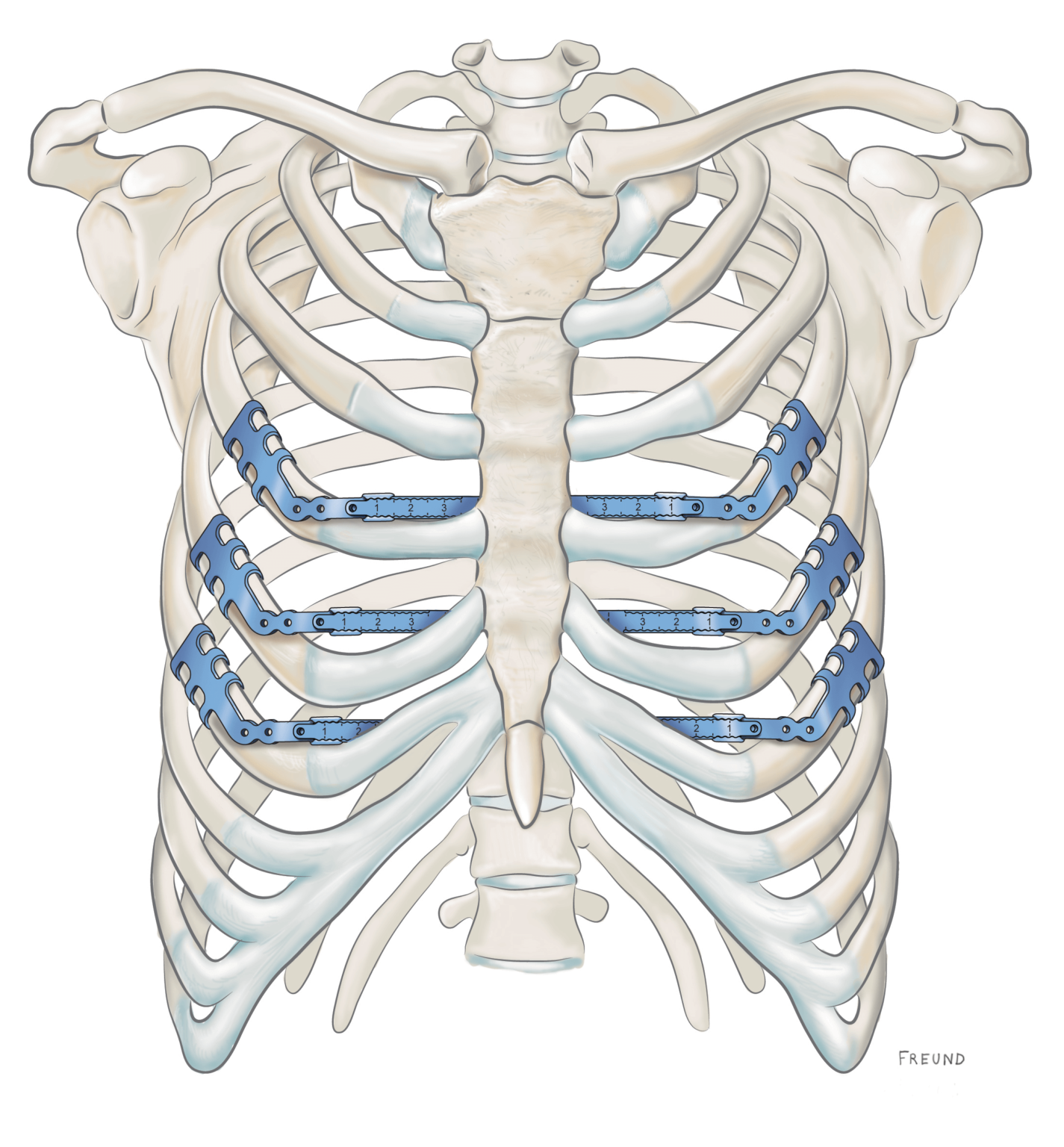 Pectus Carinatum Fr Medical