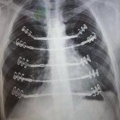 SONDAS TORÁCICAS – FR Medical